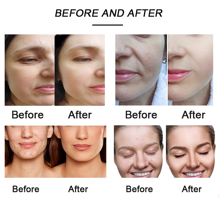 Portable Ozone Plasma Beauty Eye Lift Plasma Ozone Device For Facial ...